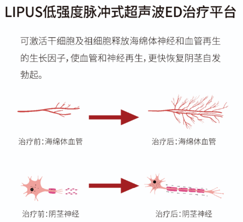 ED患者福音——LIPUS（低能量超声波）治疗仪_阳痿 - 好大夫在线