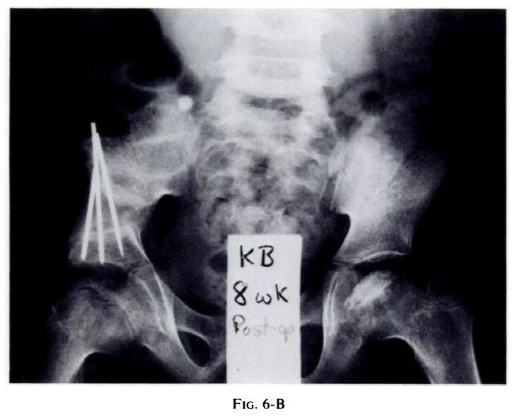 LCPD特发性儿童股骨头坏死：Legg-Calvé-Perthes病的三联截骨术_小儿股骨头坏死_小儿股骨头坏死治疗方式 - 好大夫在线