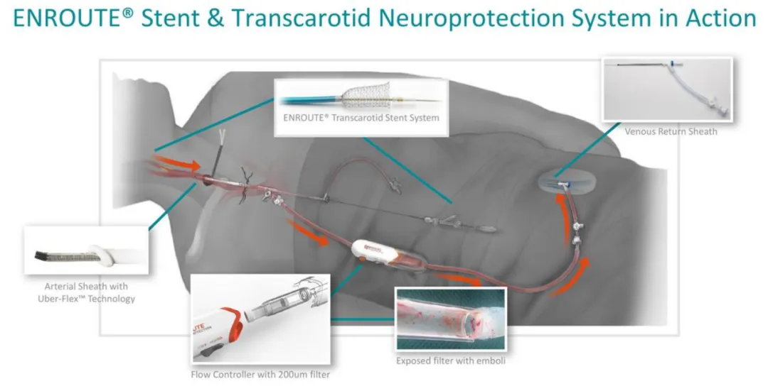 经颈动脉血运重建(TCAR)_颈动脉狭窄_颈动脉狭窄治疗方式 - 好大夫在线