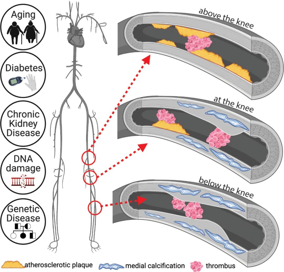 膝下动脉闭塞：治疗前血管准备与腔内治疗方法_动脉硬化闭塞症_动脉硬化闭塞症治疗方式 - 好大夫在线