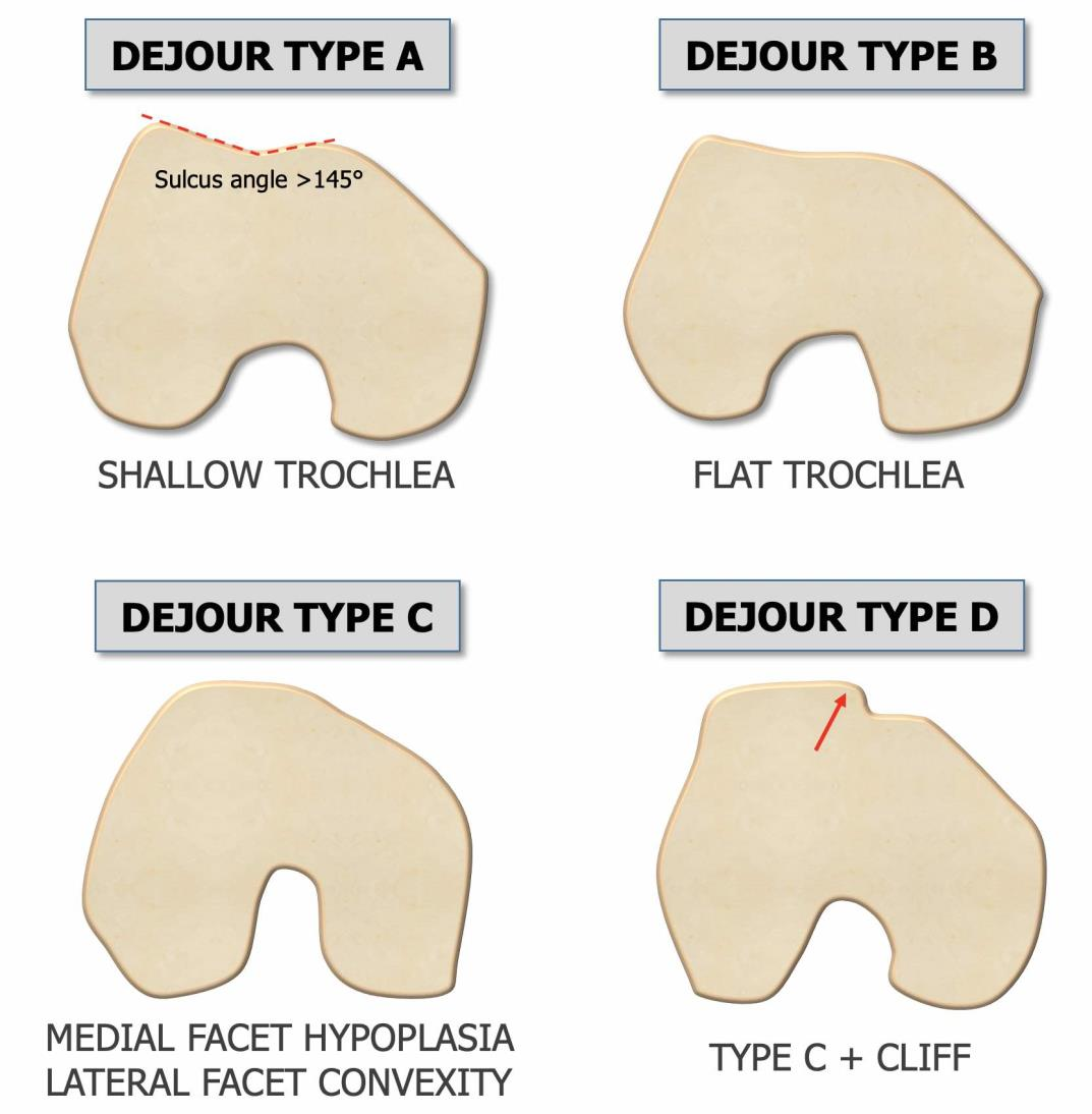 髌骨不稳定的诊断与治疗_股骨滑车发育不良Dejour分型（2023） - 好大夫在线