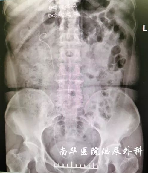 超微通道经皮肾镜Supermini PCNL (SMP)结石患者的福音 - 好大夫在线