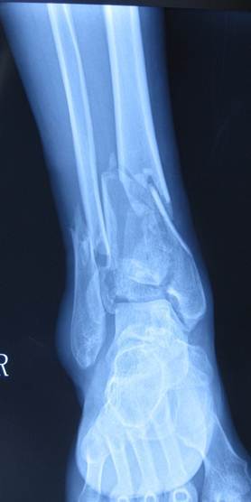 微创手术(MIPO)治疗粉碎性胫腓骨下端(pilon)骨折二 - 好大夫在线