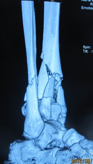 微创手术(MIPO)治疗粉碎性胫腓骨下端(pilon)骨折二 - 好大夫在线