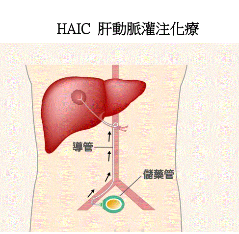 晚期肝癌治疗新选择：肝动脉灌注化疗（HAIC）_肝癌_肝癌治疗方式 - 好大夫在线