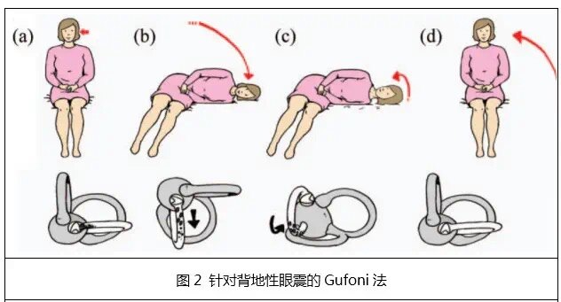 Gufoni手法复位治疗水平半规管耳石症1例_耳石症_耳石症治疗方式 - 好大夫在线