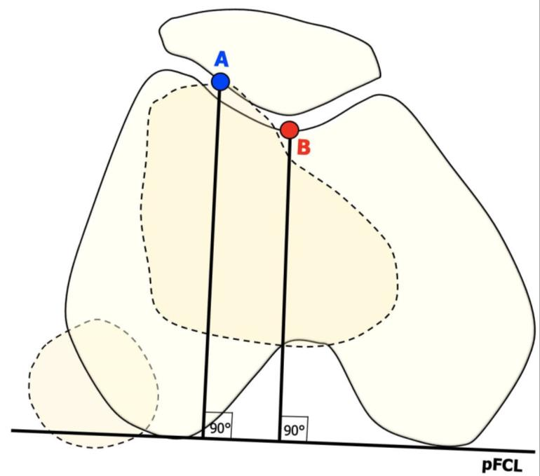 髌骨不稳定的诊断与治疗_股骨滑车发育不良Dejour分型（2023） - 好大夫在线