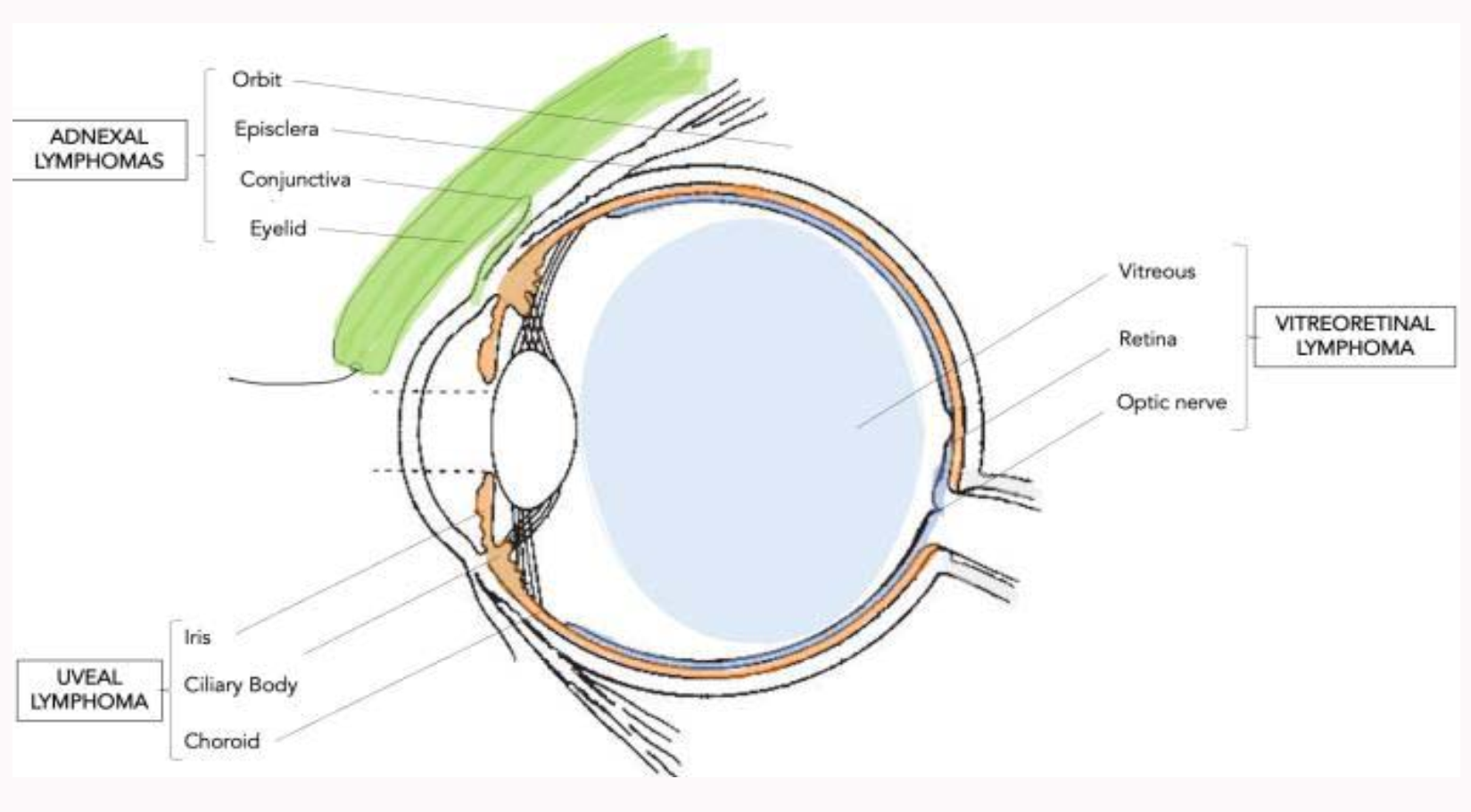 原发眼部淋巴瘤（Primary ocular lymphoma）的疾病分类和分子学特征概述_淋巴瘤_淋巴瘤介绍 - 好大夫在线