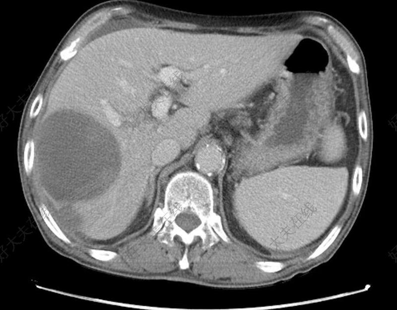 晚期肝癌转化手术治疗_肝癌 - 好大夫在线